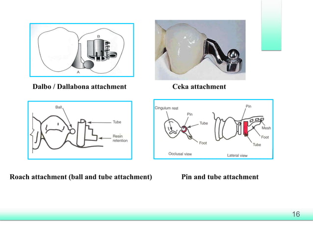 Attachments in removable partial prosthesis | PPTX