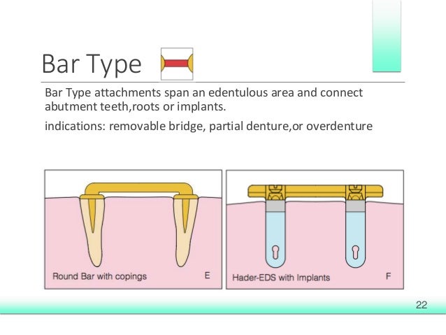Attachments in removable partial prosthesis