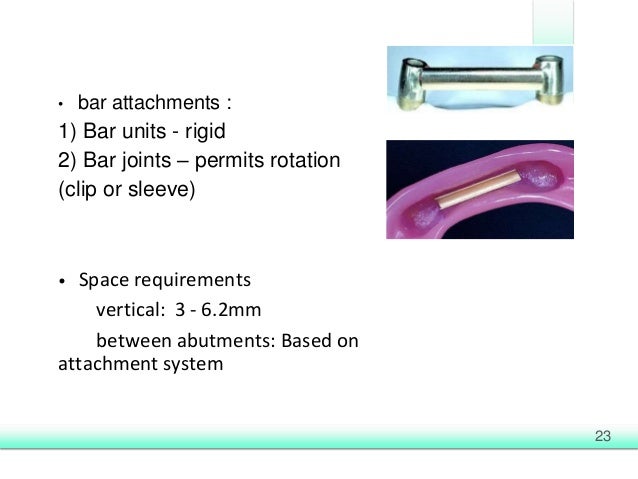 Attachments in removable partial prosthesis