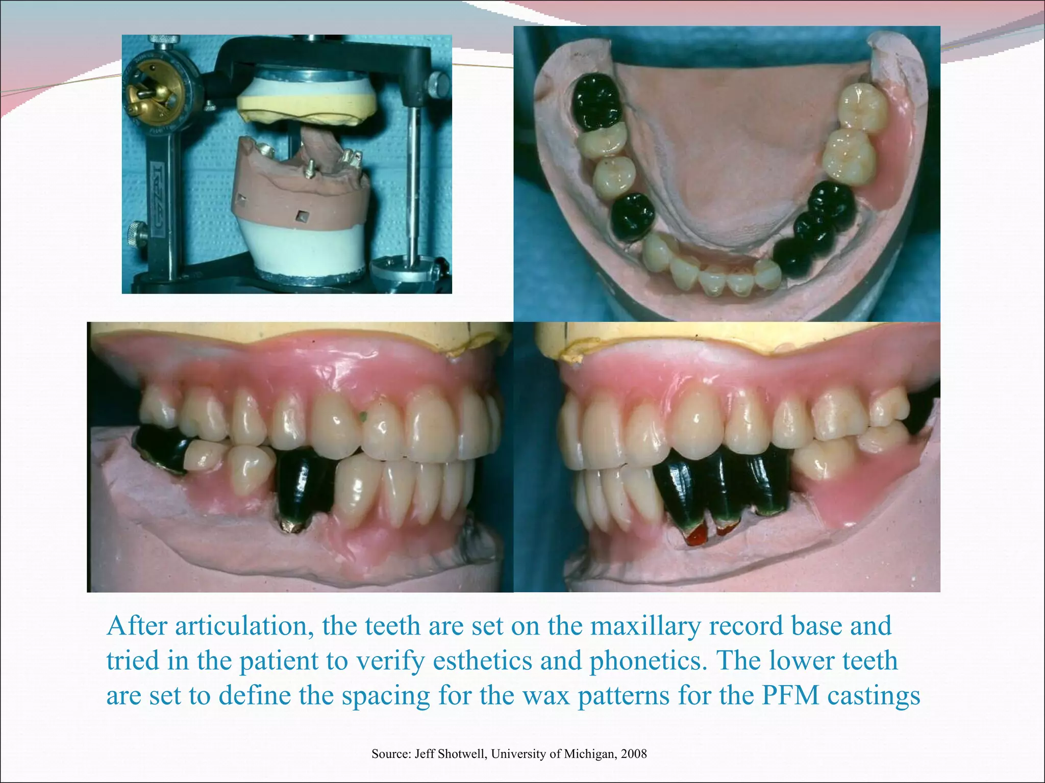 Attachments & their use in rpd fabrication | PPT