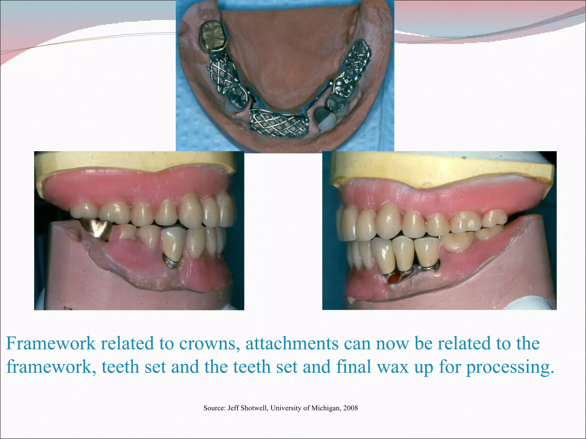Attachments & their use in rpd fabrication | PPT