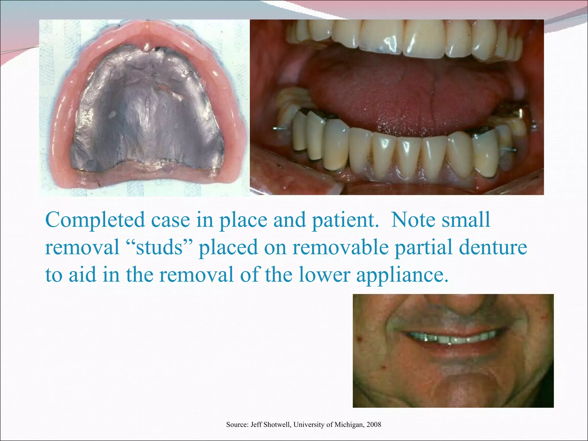 Attachments & their use in rpd fabrication | PPT