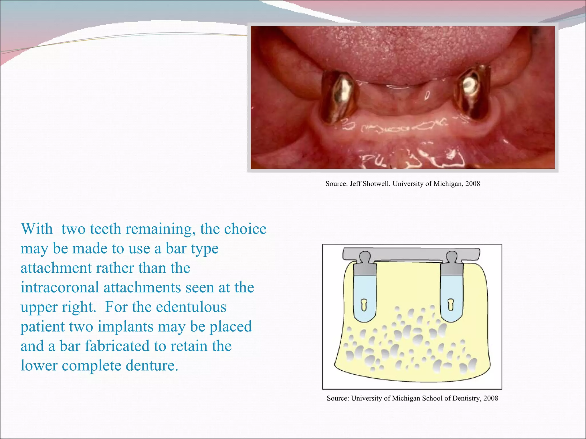 Attachments & their use in rpd fabrication | PPT