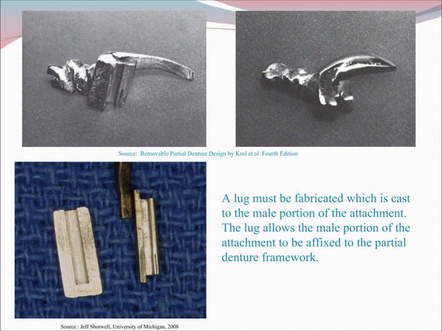Attachments & their use in rpd fabrication | PPT