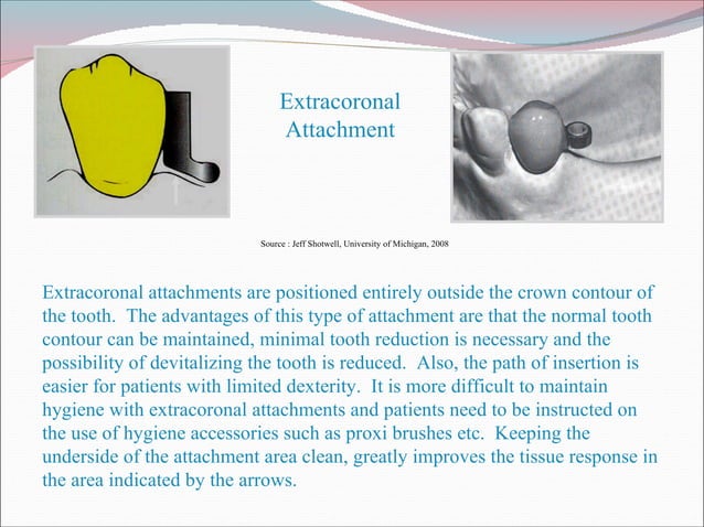 Attachments & their use in rpd fabrication | PPT