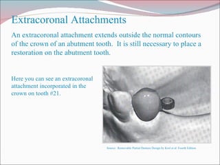 Attachments & their use in rpd fabrication | PPT