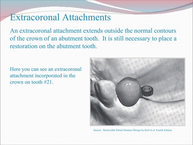 Attachments & their use in rpd fabrication | PPT