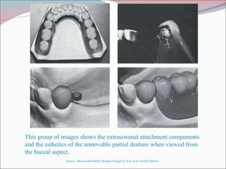 Attachments & their use in rpd fabrication | PPT