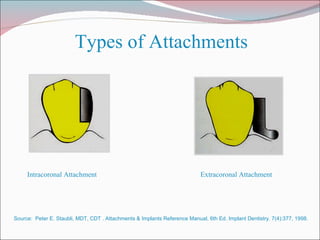 Attachments & their use in rpd fabrication | PPT