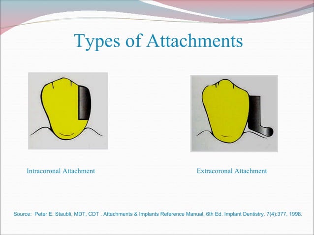Attachments & their use in rpd fabrication | PPT