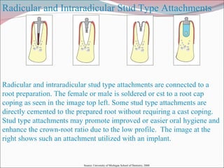 Attachments & their use in rpd fabrication | PPT