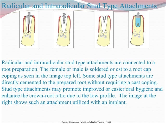 Attachments & their use in rpd fabrication | PPT
