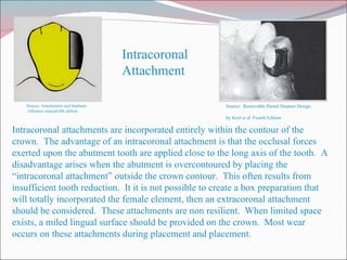 Attachments & their use in rpd fabrication | PPT