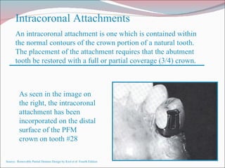 Attachments & their use in rpd fabrication | PPT