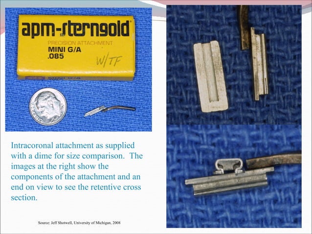 Attachments & their use in rpd fabrication | PPT