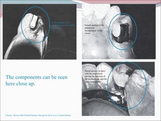 Attachments & their use in rpd fabrication | PPT