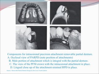 Attachments & their use in rpd fabrication | PPT