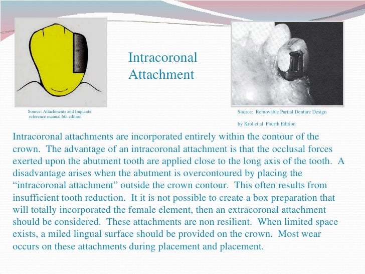 Attachments & their use in rpd fabrication