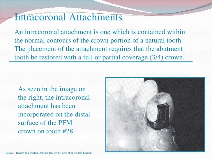 Attachments & their use in rpd fabrication