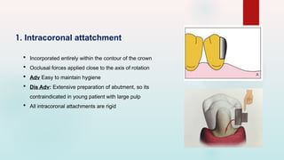 Attachment in Removable Prosthodontics: definition, Types ...