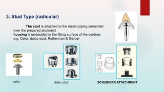 Attachment in Removable Prosthodontics: definition, Types ...