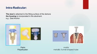 Attachment in Removable Prosthodontics: definition, Types ...