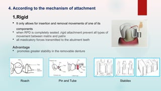 Attachment in Removable Prosthodontics: definition, Types ...