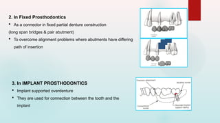Attachment in Removable Prosthodontics: definition, Types ...