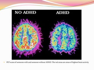 Attention Deficit Hyperactivity Disorder | PPTX