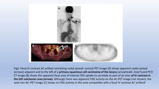Attenuation correction factor and pet/ct artefacts H&N | PPTX
