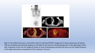 Attenuation correction factor and pet/ct artefacts H&N | PPTX