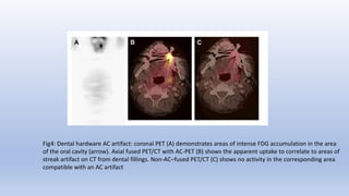 Attenuation correction factor and pet/ct artefacts H&N | PPTX