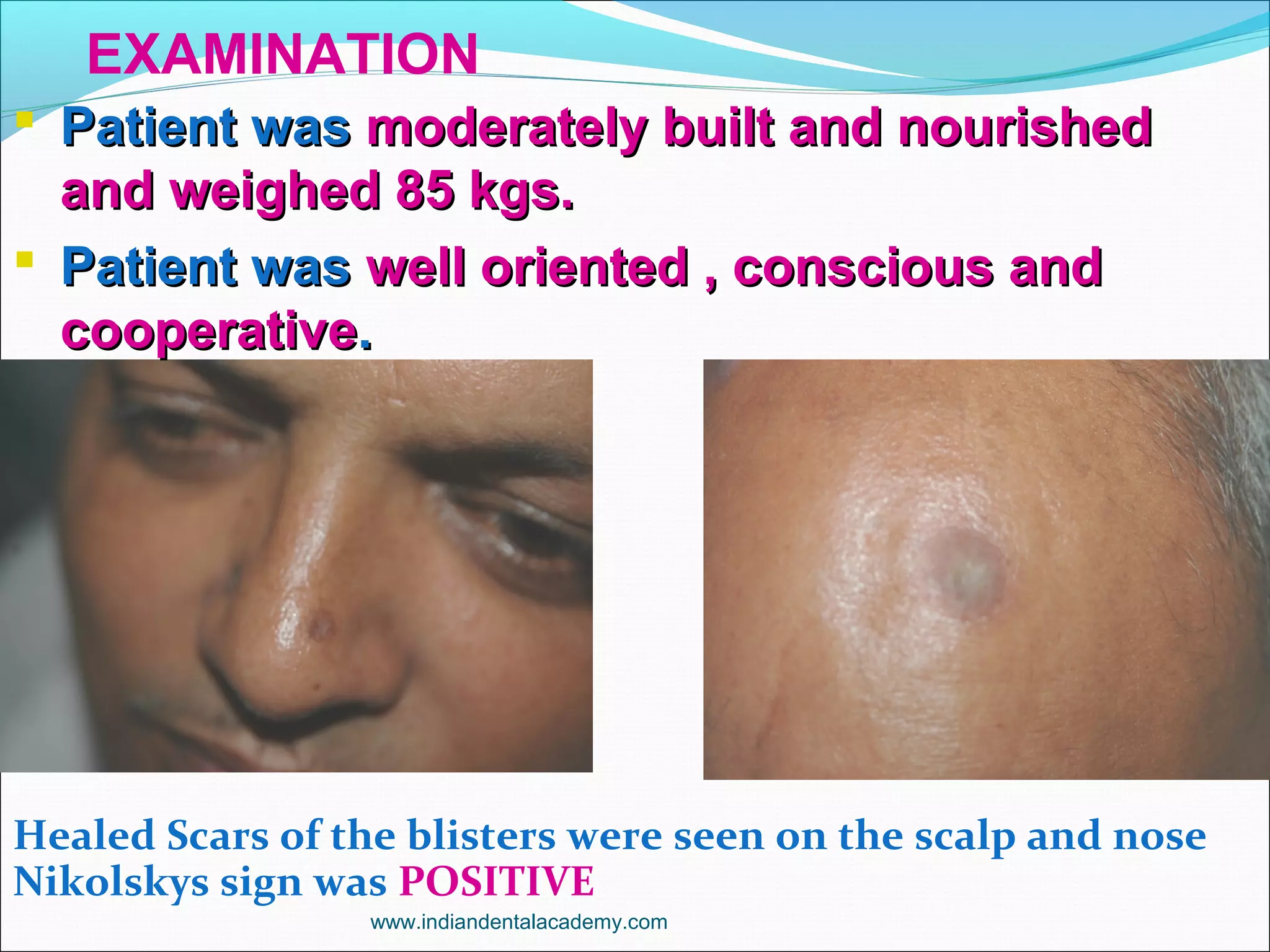 pemphigus vulgaris/ dental courses | PPT