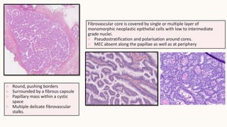 Dealing with ATYPIA and papillary lesions in IN BREAST | PPTX