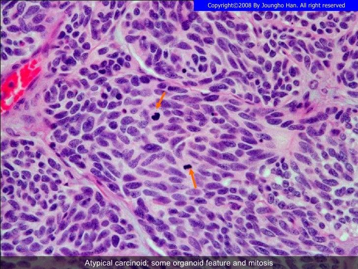 Atypical Carcinoid