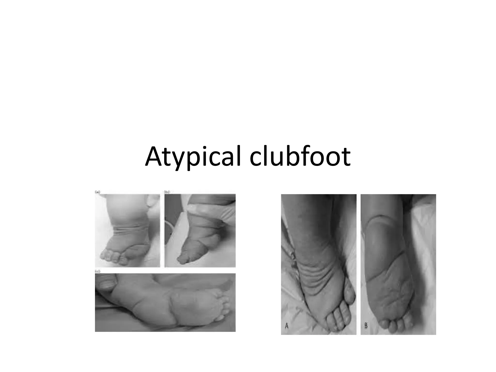 Atypical clubfoot, complex ctev, dx.pptx