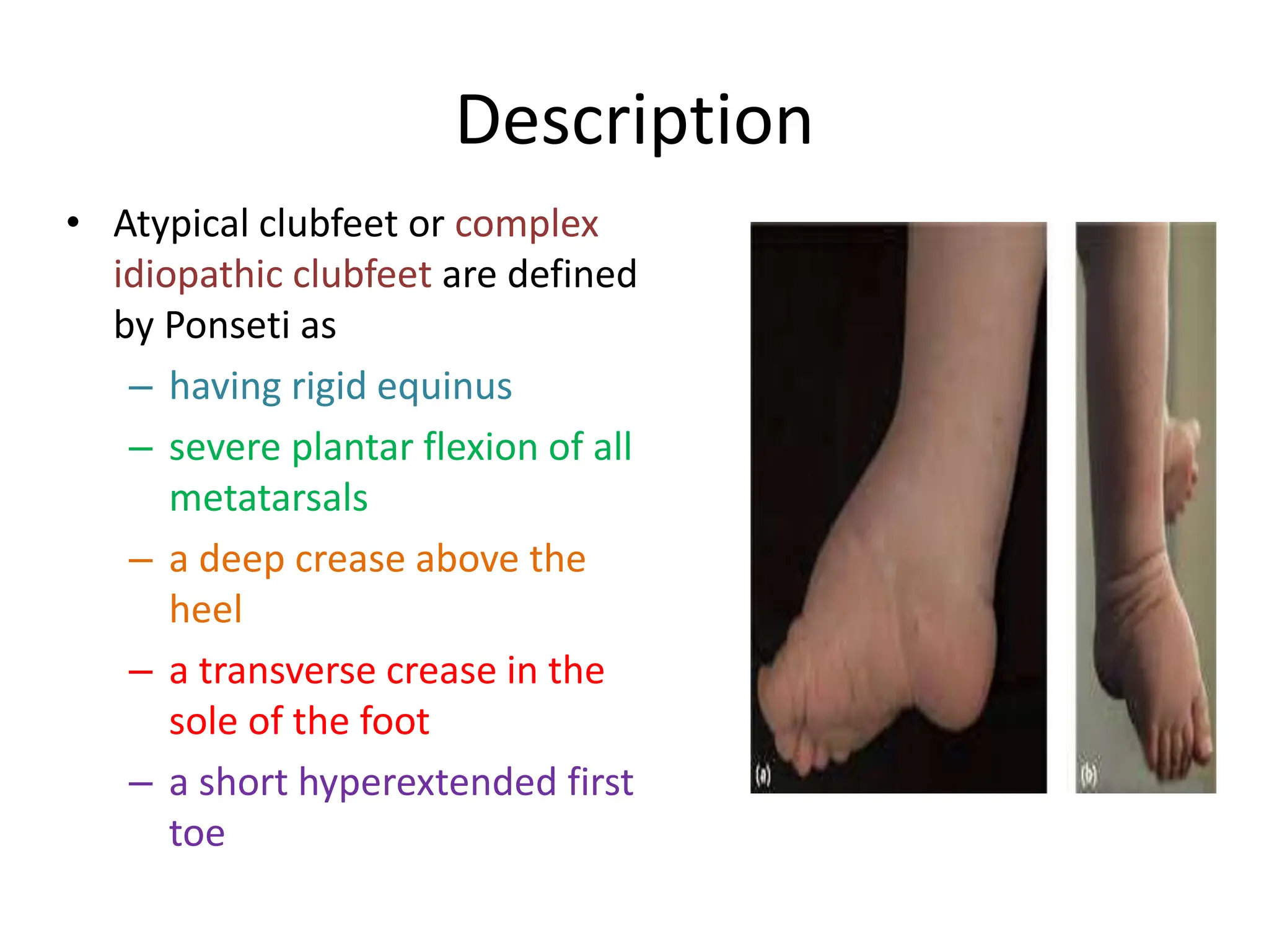 Atypical clubfoot, complex ctev, dx.pptx
