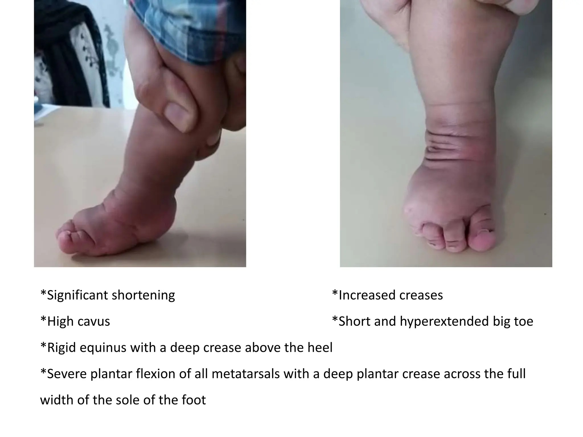 Atypical clubfoot, complex ctev, dx.pptx