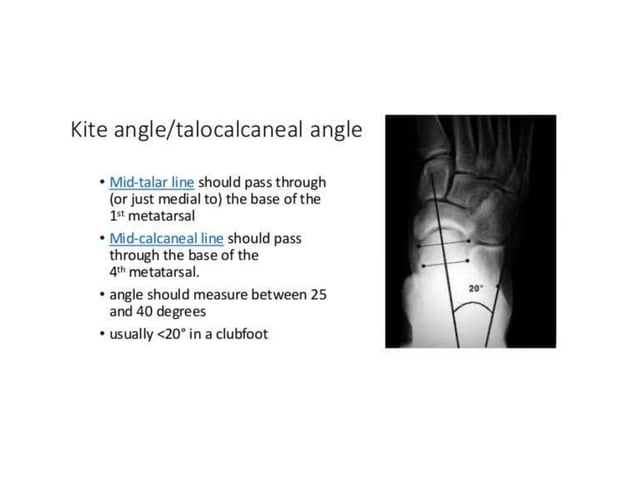 Atypical clubfoot, complex ctev, dx.pptx