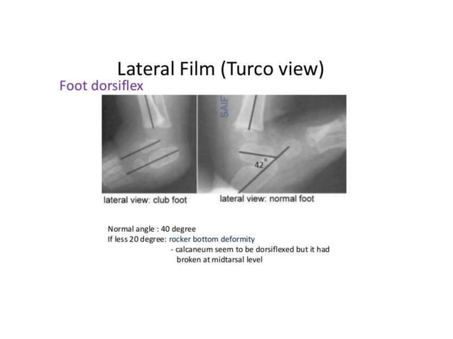 Atypical clubfoot, complex ctev, dx.pptx