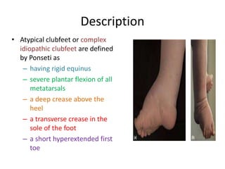 Atypical clubfoot, complex ctev, dx.pptx