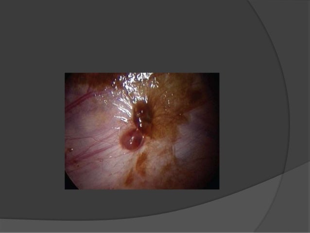 Atypical endometriosis