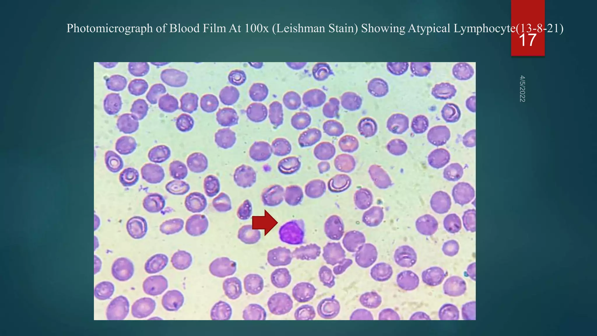 Atypical lymphocytes | PPT