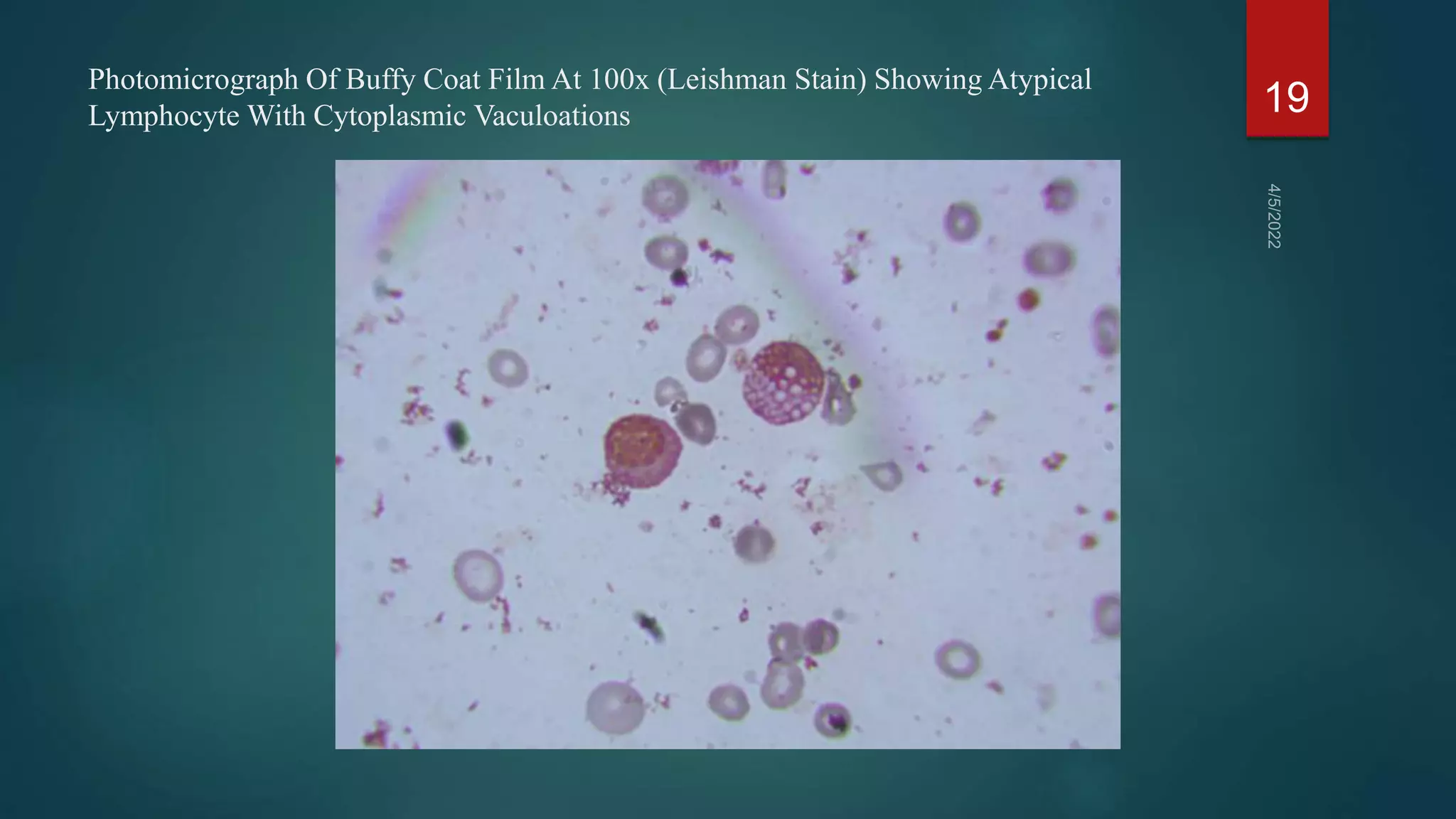 Atypical lymphocytes | PPT