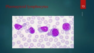 Atypical lymphocytes | PPT