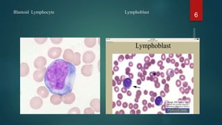 Atypical lymphocytes | PPT