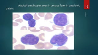 Atypical Lymphocytes Dengue