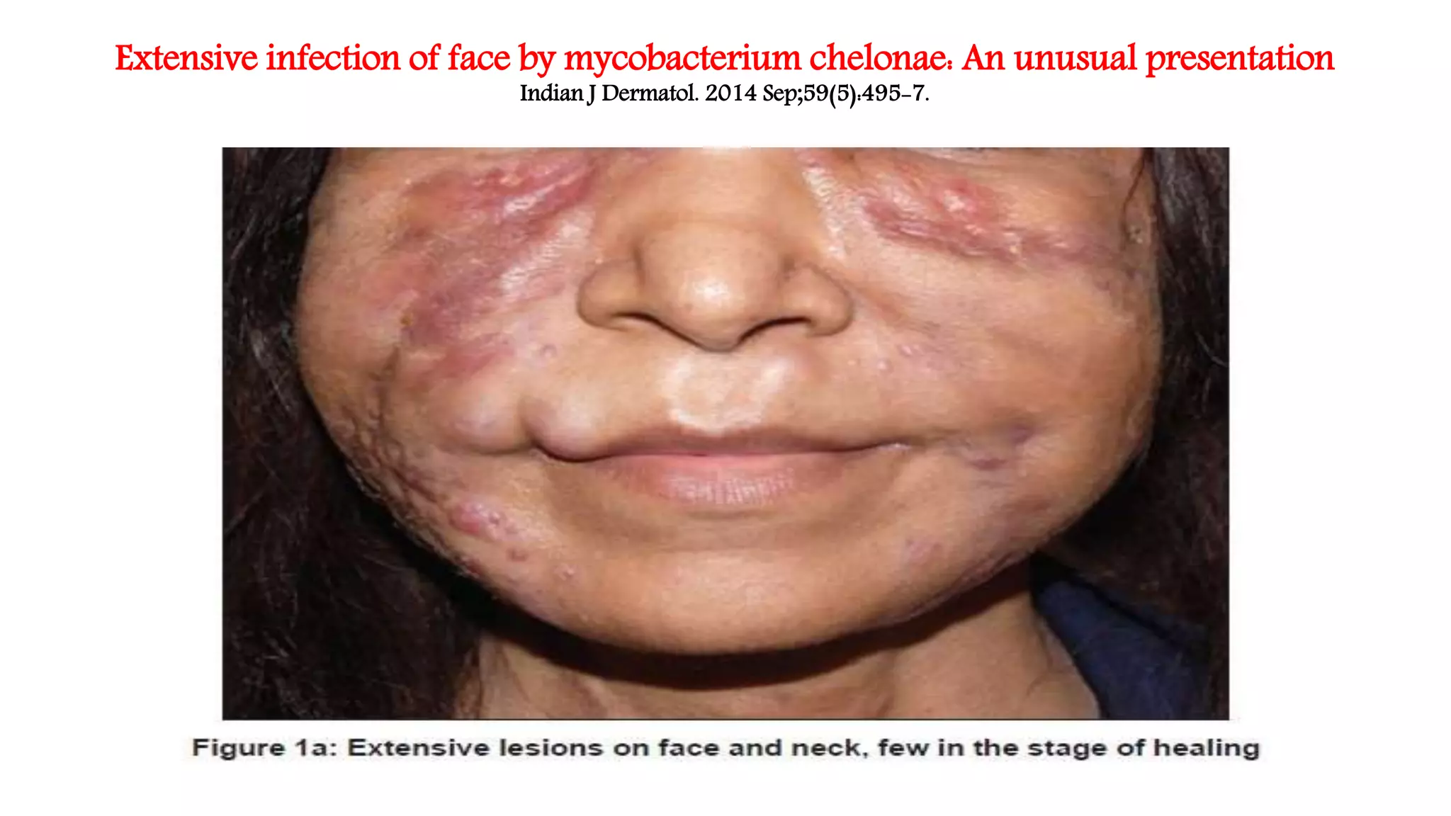 Atypical mycobacterial infections in dermatology | PPTX