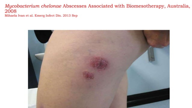 Atypical mycobacterial infections in dermatology | PPTX | Infectious ...
