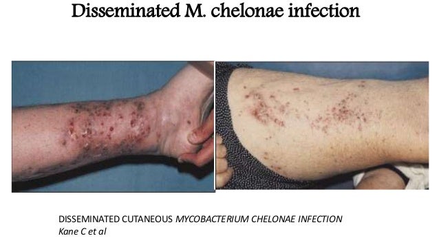 Atypical mycobacterial infections in dermatology